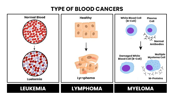 Blood Cancer And CAR T-Cell Therapy - CG Therapeutics